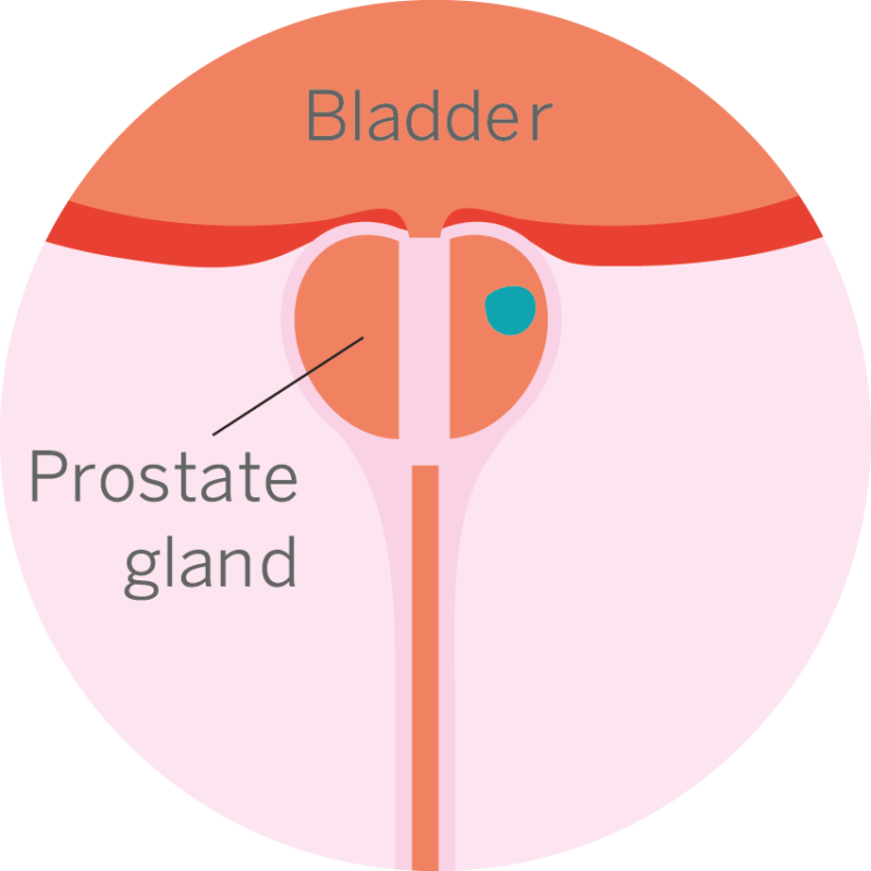 Staging and grading - Prostate Cancer Research