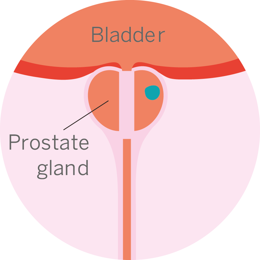 Staging and grading - Prostate Cancer Research