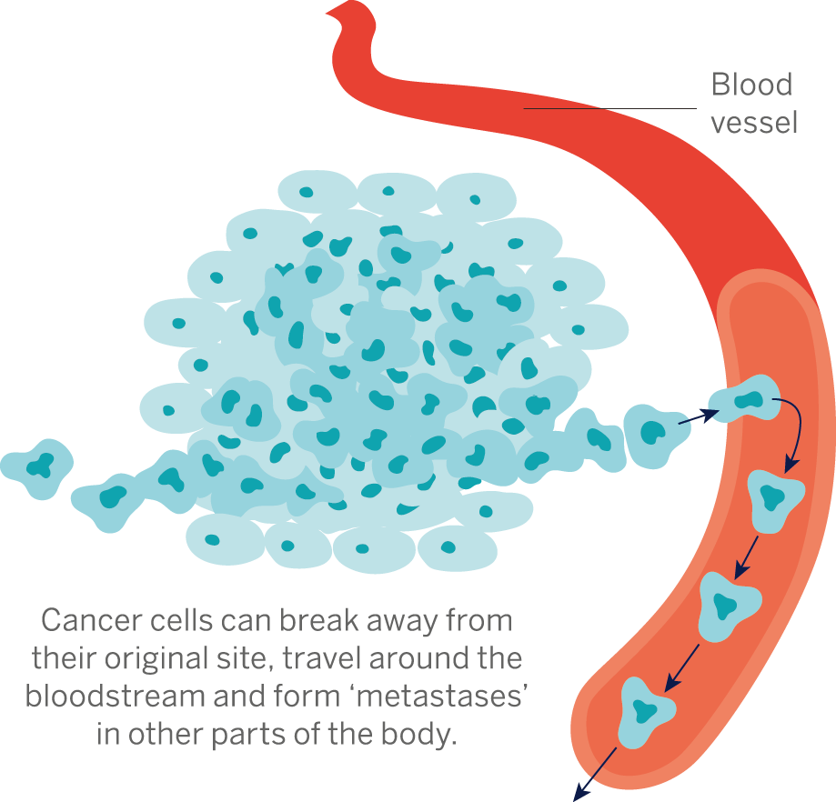 Stopping the spread- two years on - Prostate Cancer Research