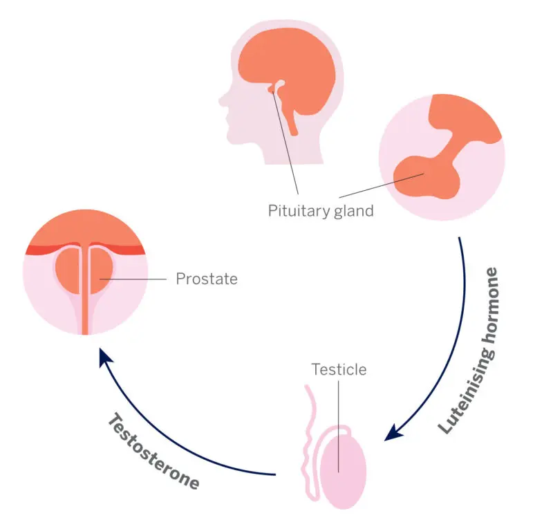 Understanding treatment choices - Prostate Cancer Research