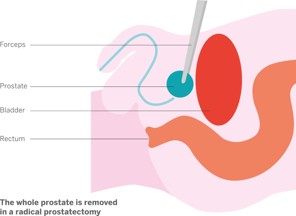 Radical Prostatectomy - Prostate Cancer Research