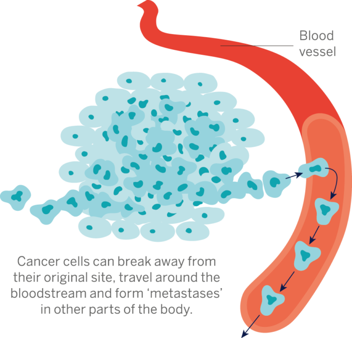 Revolutionising prostate cancer bone metastasis treatment