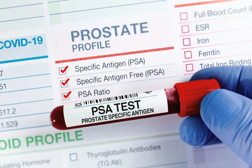 The PSA test - Prostate Cancer Research